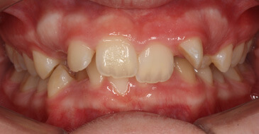Smile Gallery | Patient Results | SmileStyle Orthodontics